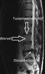 MRI en lage rugpijn: een haat-liefde verhouding | Osteo Actief